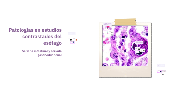 Patologías en estudios contrastados del esófago by Jose Orozco Narvaez ...