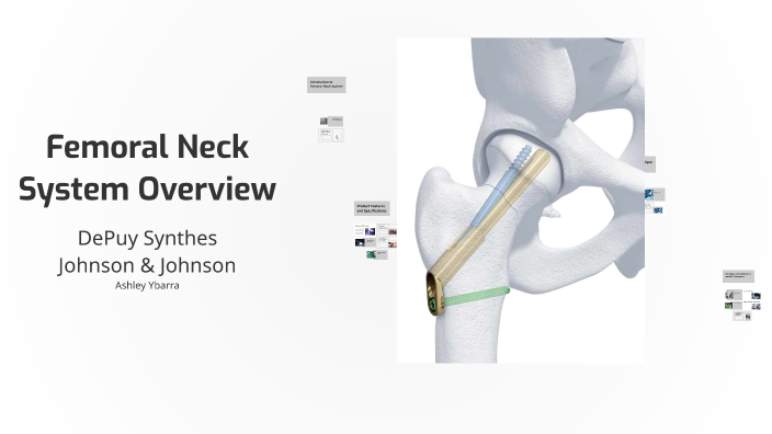 Femoral Neck System Overview by Ashley Ybarra on Prezi