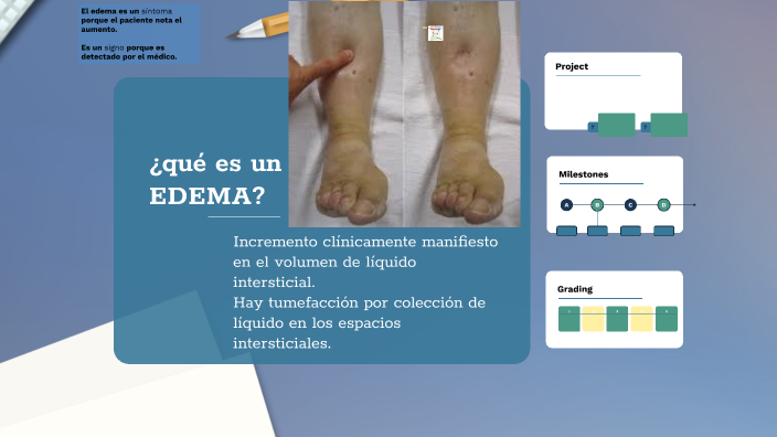 Sd. Edematoso by Rosa Benitez on Prezi