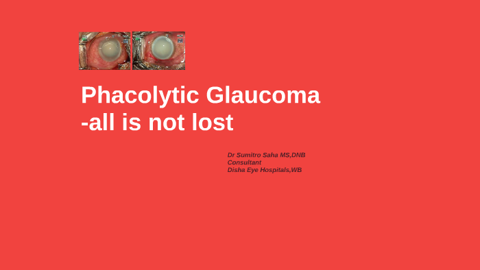 Phacolytic Glaucoma by Sumitro Saha on Prezi
