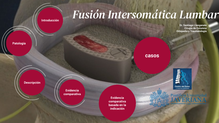 FUSIÓN INTERSOMÁTICA LUMBAR by luis santiago llanganate narvaez on Prezi