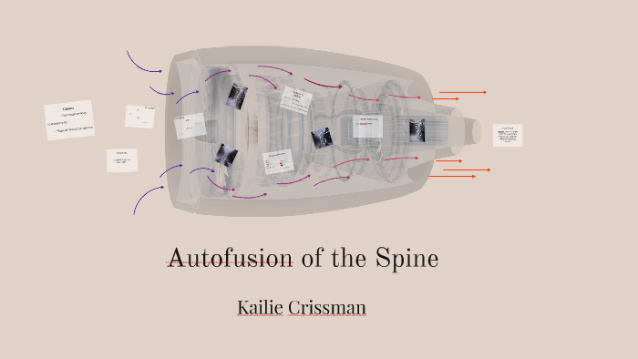 Autofusion of the Spine by Kailie Crissman on Prezi