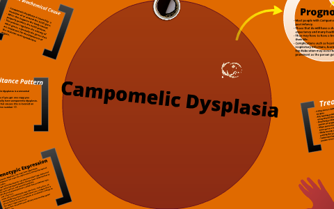 Campomelic Dysplasia by Faith Stirm on Prezi