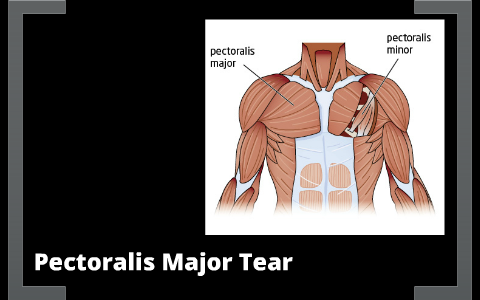Clinical Case: Pectoralis Major tear by Irving Faverman on Prezi
