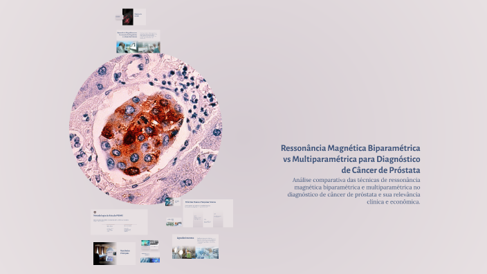 Ressonância Magnética Biparamétrica vs Multiparamétrica para ...