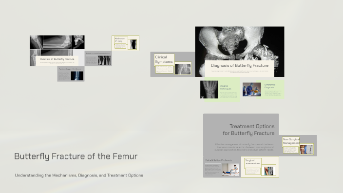 Butterfly Fracture of the Femur by Kayla Grubb on Prezi