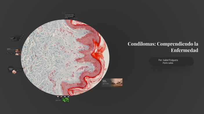 Condilomas: Comprendiendo la Enfermedad by Isabel Fulguera on Prezi