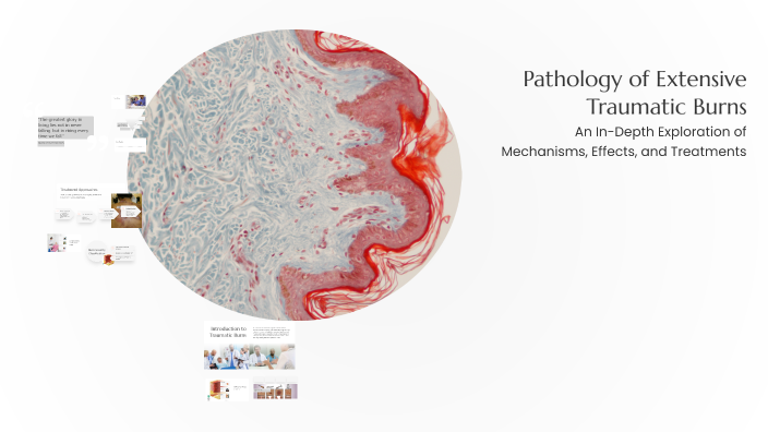Pathology of Extensive Traumatic Burns by Keyra Hoffman on Prezi