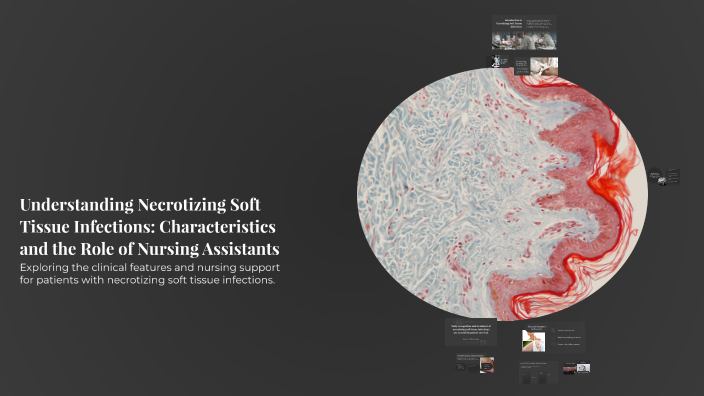 Understanding Necrotizing Soft Tissue Infections: Characteristics and ...