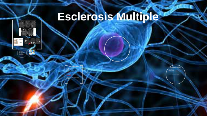 Esclerosis Multiple by michelle lizana mena on Prezi