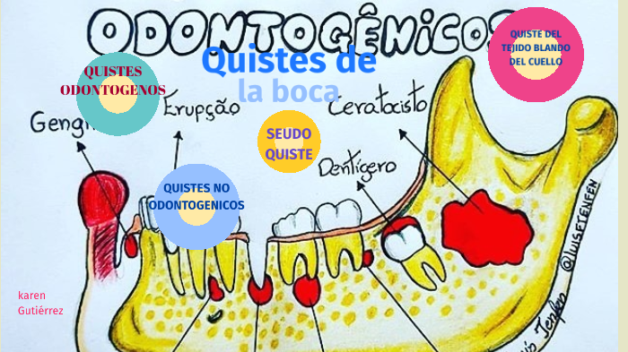 Quistes de la boca by zucy gm on Prezi