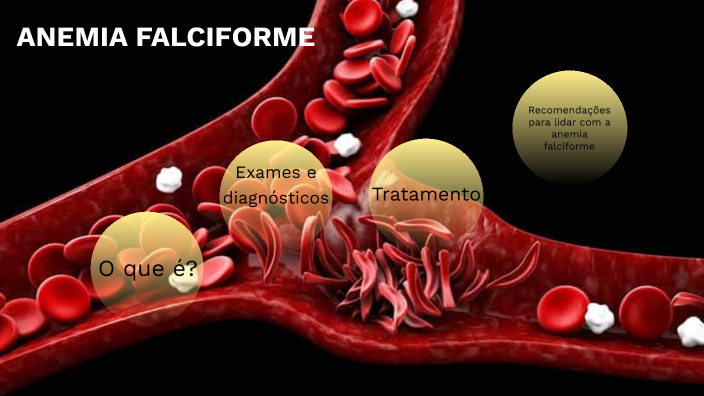 Anemia Falciforme by Ianca Monteiro on Prezi