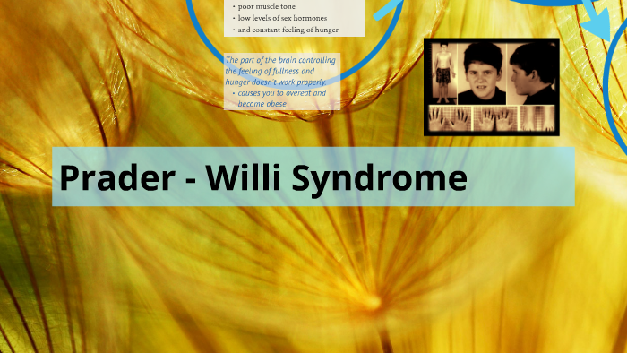 Prader - Wili Syndrome/ Angelman Syndrome by Daja Walker on Prezi