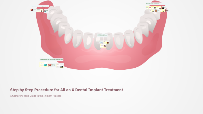 Step by Step Procedure for All on X Dental Implant Treatment by chadi ...