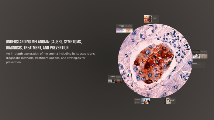 Understanding Melanoma: Causes, Symptoms, Diagnosis, Treatment, and ...