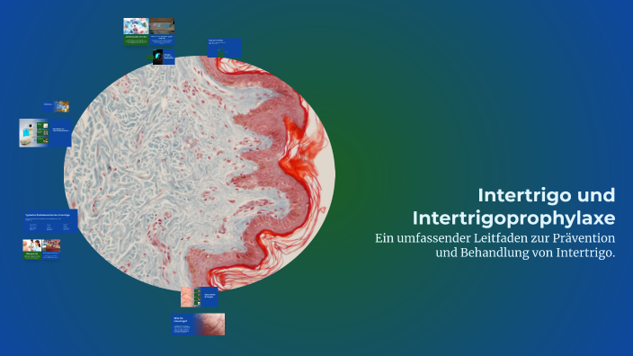 Intertrigo und Intertrigoprophylaxe by Annika Hesse on Prezi
