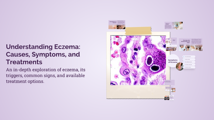 Understanding Eczema: Causes, Symptoms, and Treatments by Marissa ...