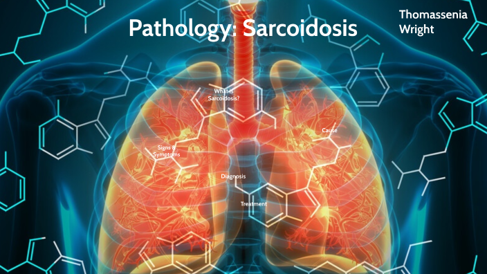 Pathology: Sarcoidosis by Thomassenia Wright on Prezi