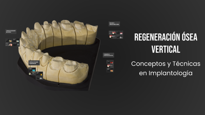 Regeneración Ósea Vertical by Sebastián García on Prezi