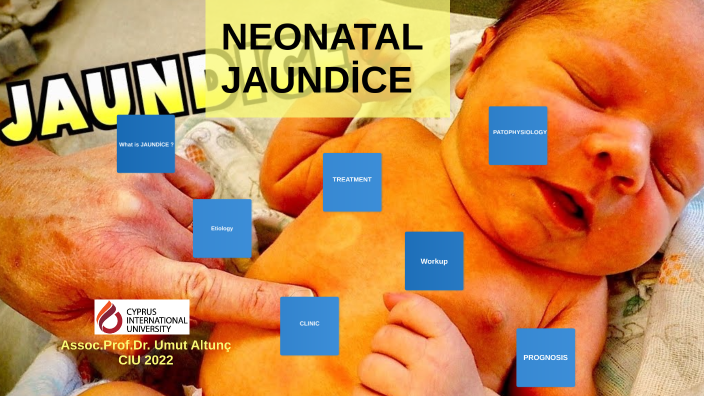 Neonatal Jaundice by deniz altunc on Prezi