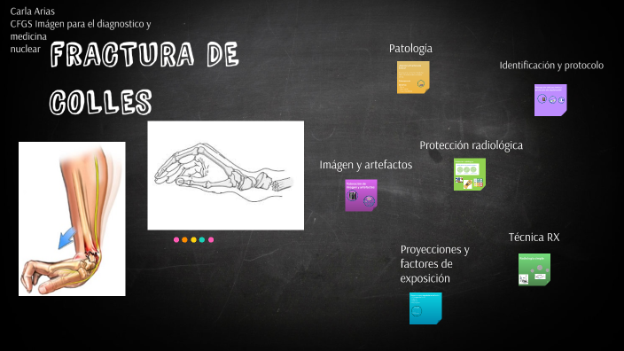 Fractura de Colles by carla arias on Prezi