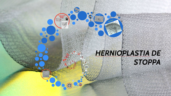 HERNIOPLASTIA DE STOPPA by ANIBAL CARRASCO on Prezi
