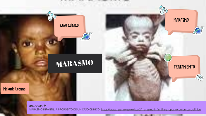 MARASMO by Melanie Lozano on Prezi