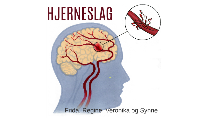 HJERNESLAG by Synne Helen Olsen on Prezi