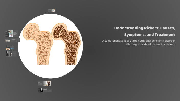 Understanding Rickets: Causes, Symptoms, and Treatment by sukhmani kaur ...