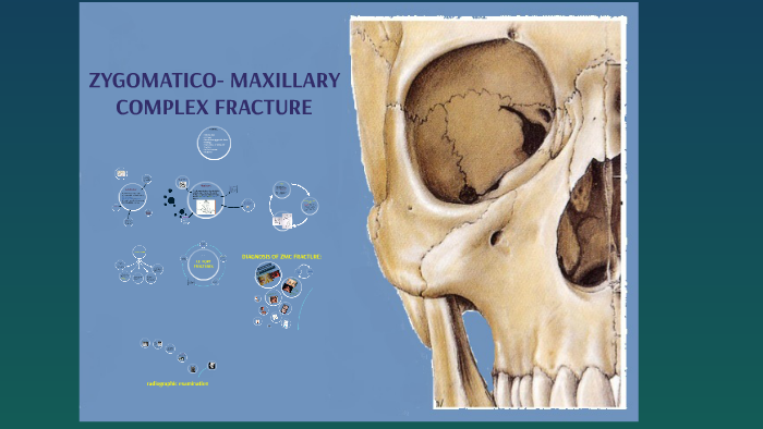 ZYGOMATICO- MAXILLARY COMPLEX FRACTURE by ŅeŖmệëń Ǻḿli on Prezi