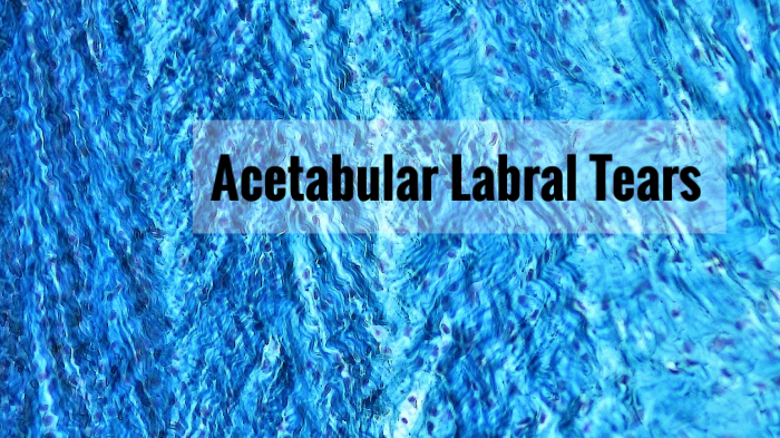 Acetabular Labral Tears by Danielle Serna on Prezi