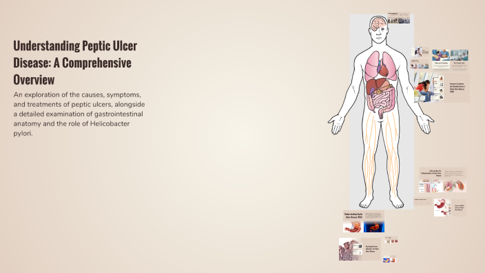 Understanding Peptic Ulcer Disease: A Comprehensive Overview by Tre ...