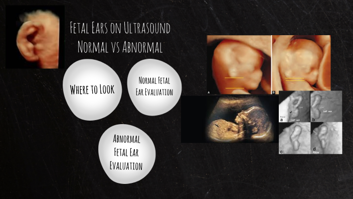 Fetal Ears by elizabeth grego on Prezi
