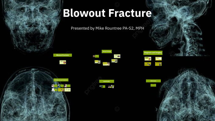 Blowout Fracture by Michael Rountree on Prezi