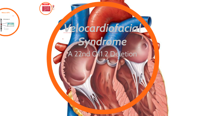 Velocardiofacial Syndrome by Ike Brower on Prezi