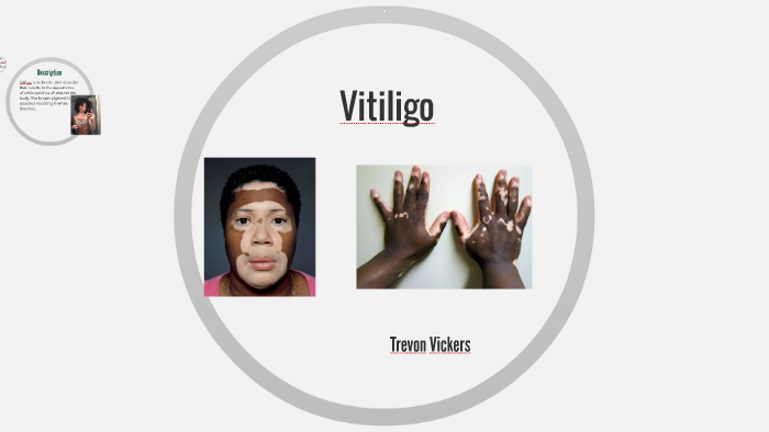 Vitiligo by Trevon Vickers on Prezi