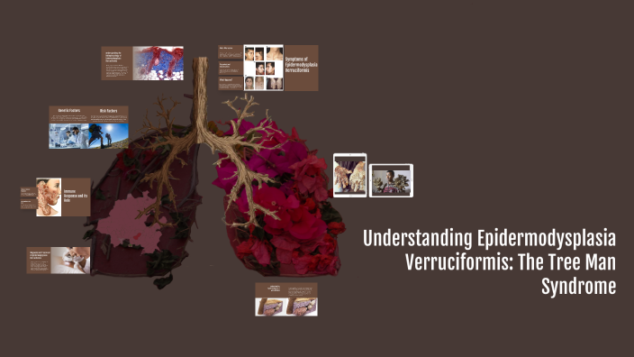 Understanding Epidermodysplasia Verruciformis: The Tree Man Syndrome by ...