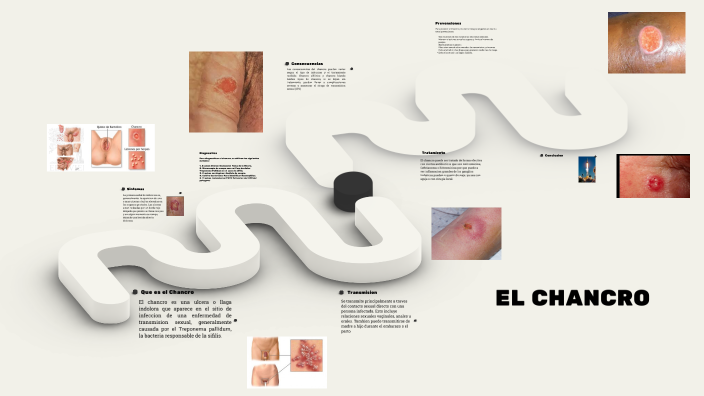 Que es el Chancro by Isabella Ruiz imbachi on Prezi