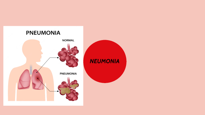 Neumonia by Lizeth Adame on Prezi