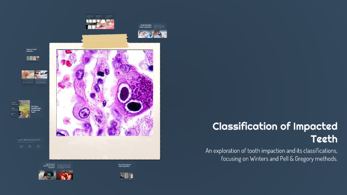 Classification of Impacted Teeth by Mauli Chaturvedi on Prezi