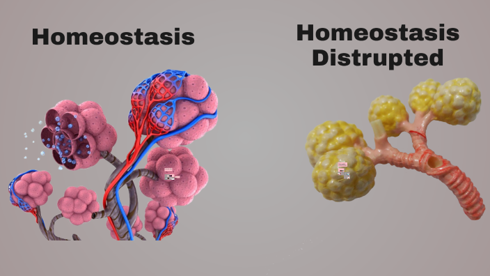 Pneumonia Model by Roi G on Prezi