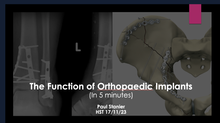 Orthopaedic Implants (Trauma) by Paul Stanier on Prezi