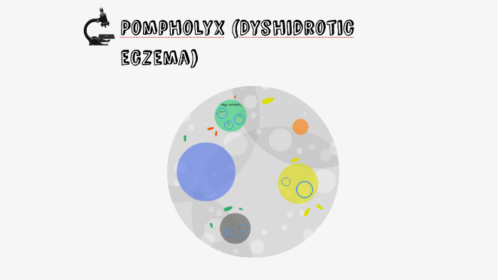 Pompholyx (dyshidrotic eczema) by reem almazroui