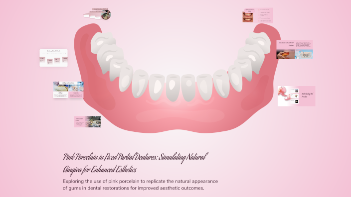 Pink Porcelain in Fixed Partial Dentures: Simulating Natural Gingiva ...