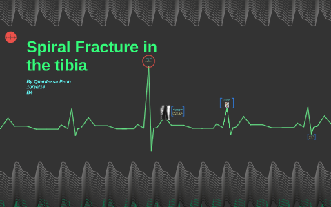 Spiral Fracture by Quantessa Penn on Prezi