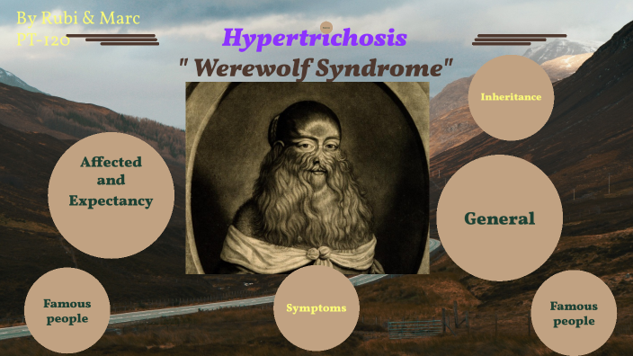 Hypertrichosis/Werewolf syndrome by marc aguilera