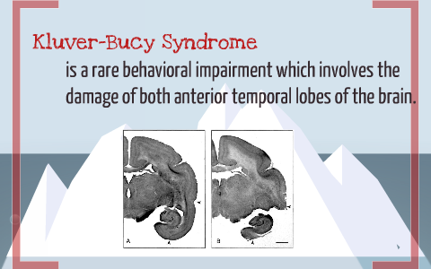 Kluver-Bucy Syndrome by Kanarra Cheerio on Prezi