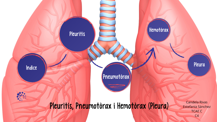 Pleuritis Pneumotòrax Hemotòrax (Pleura) by Candela Rivas Rodriguez on ...