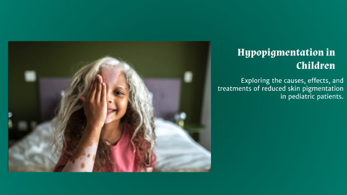 Hypopigmentation in Children by thomas shelton on Prezi