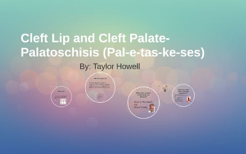 Cleft Lip and Cleft Palate- Palatoschisis (Pal-e-tas-ke-ses) by Taylor ...